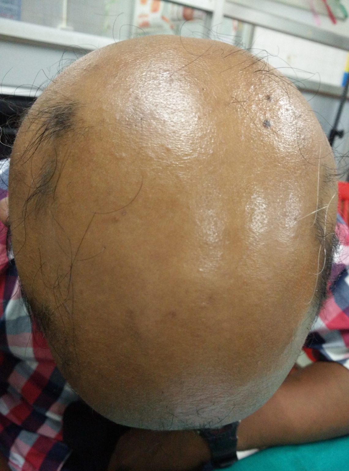 Alopecia totalis managed by Homoeopathy medicines